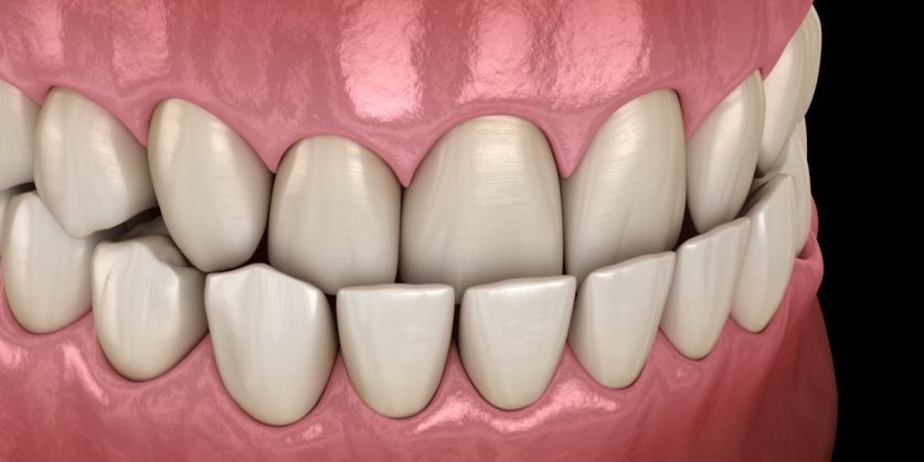 What to Know About Child Underbite?