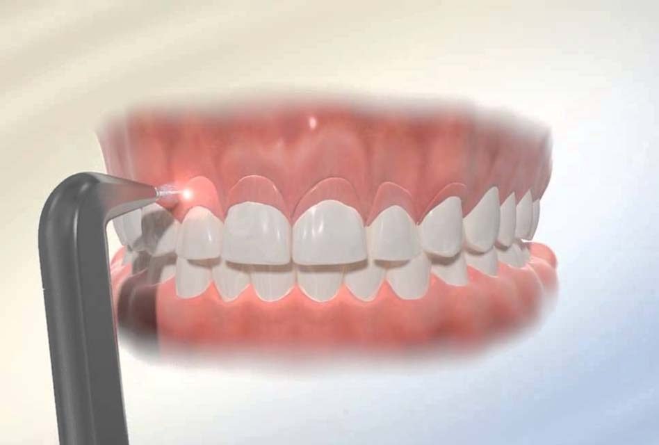 Laser Gum Removal Near Me | Gingivectomy Houston