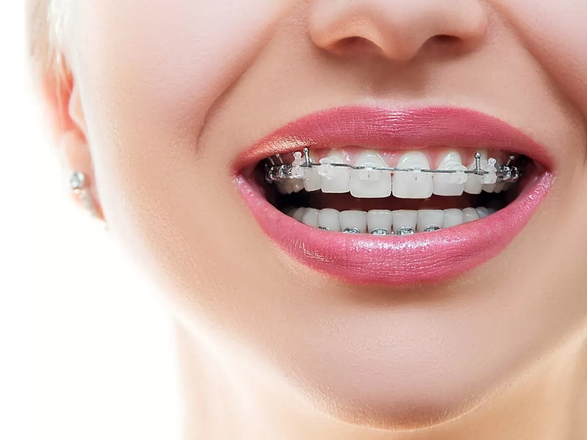 What Happens If Left An Overbite Untreated?